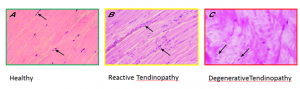 Using load management in the treatment of tendinopathy
